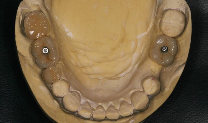 Full mouth restoration