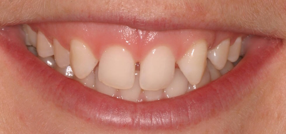 Align with Invisalign, Brighten and Contour