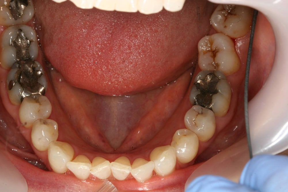 Composite to replace old amalgam fillings