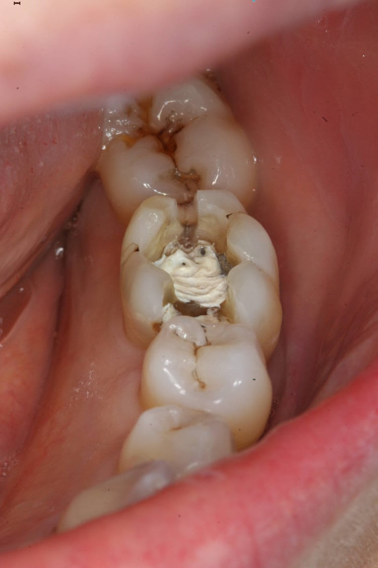 Composite to replace old amalgam fillings
