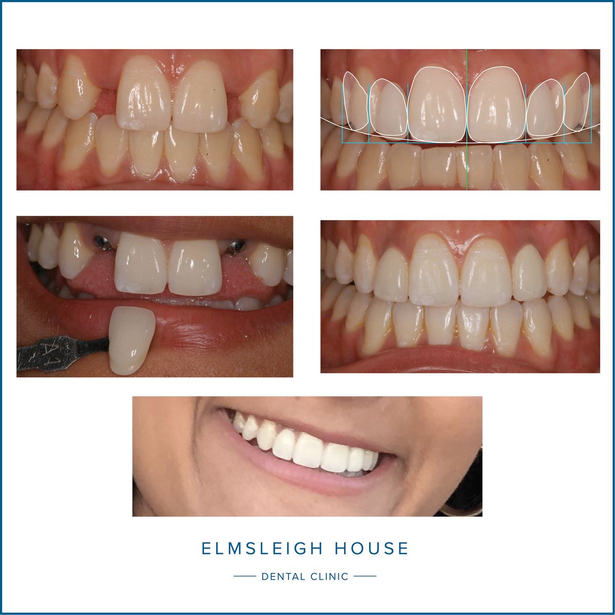 Invisalign, implants and a new smile!