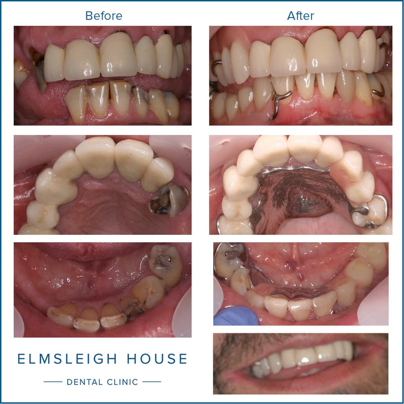 New dentures for a restored smile