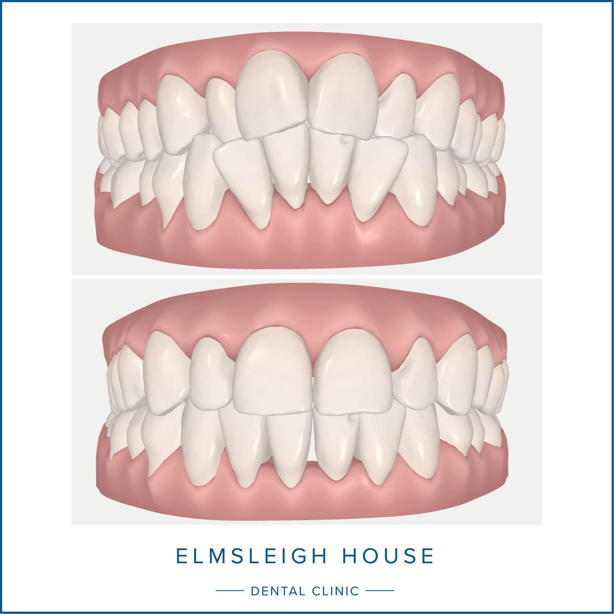 What are the benefits of Spark Aligners?