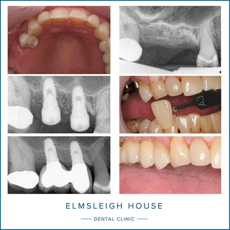 Mini sinus lifts and two dental implants to restore a gap