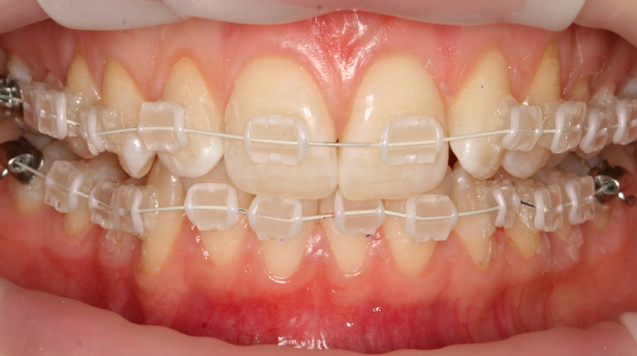 Cfast®, whitening and cosmetic bonding for a straighter, whiter smile!