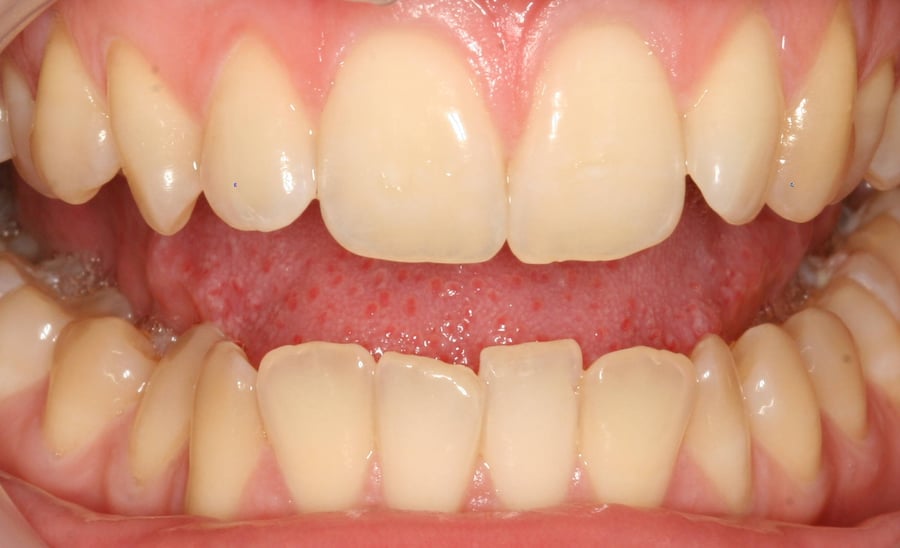 Cfast®, whitening and cosmetic bonding for a straighter, whiter smile!