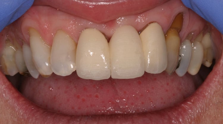 Restoration with a three-tooth bridge