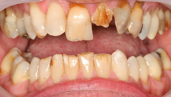Restoration with a three-tooth bridge