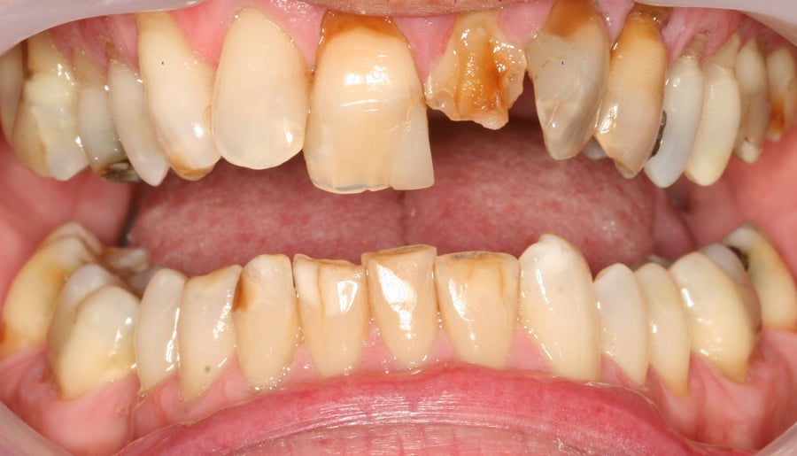 Restoration with a three-tooth bridge