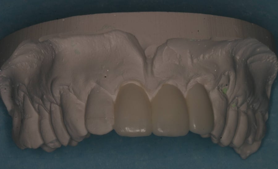 Restoration with a three-tooth bridge