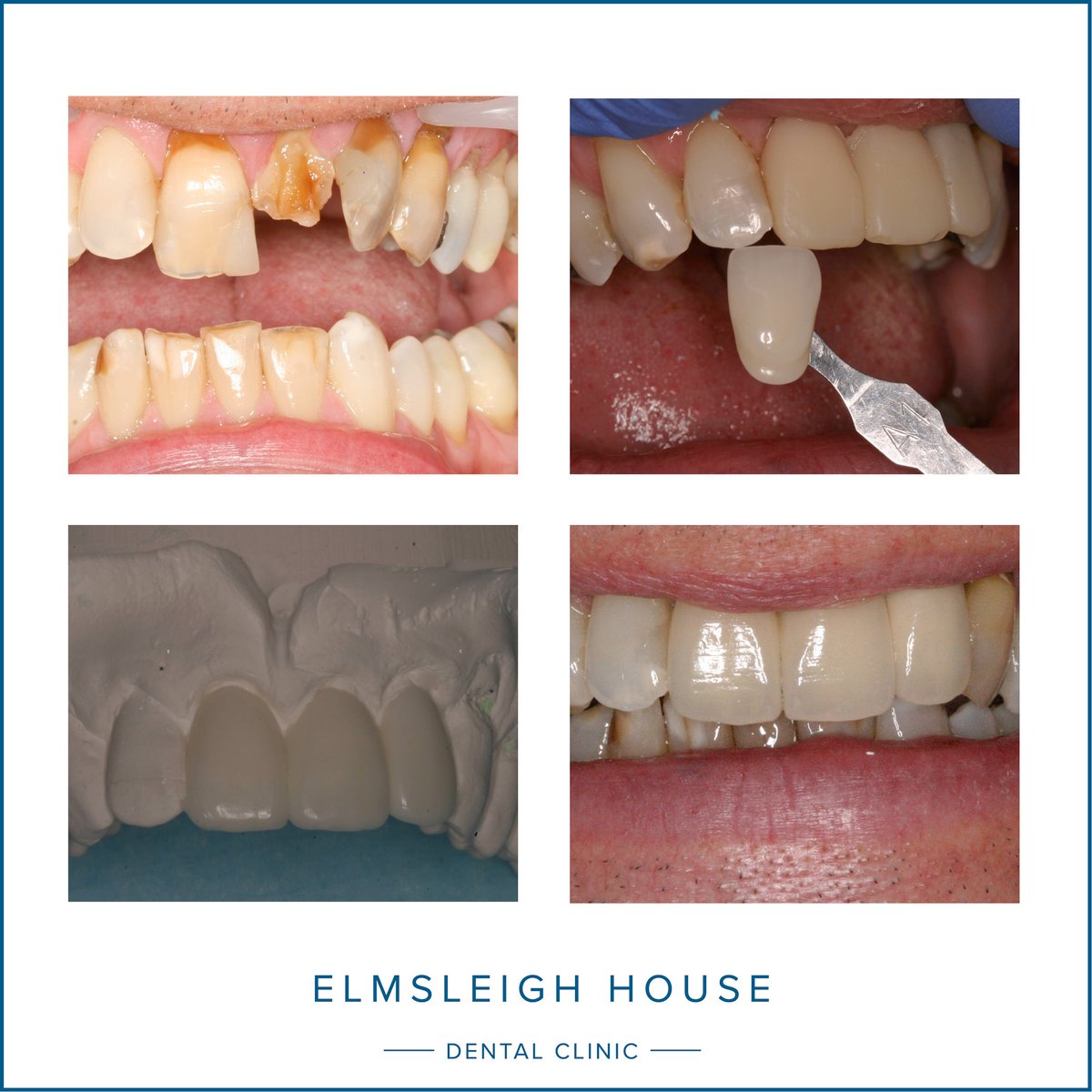 Restoration with a three-tooth bridge