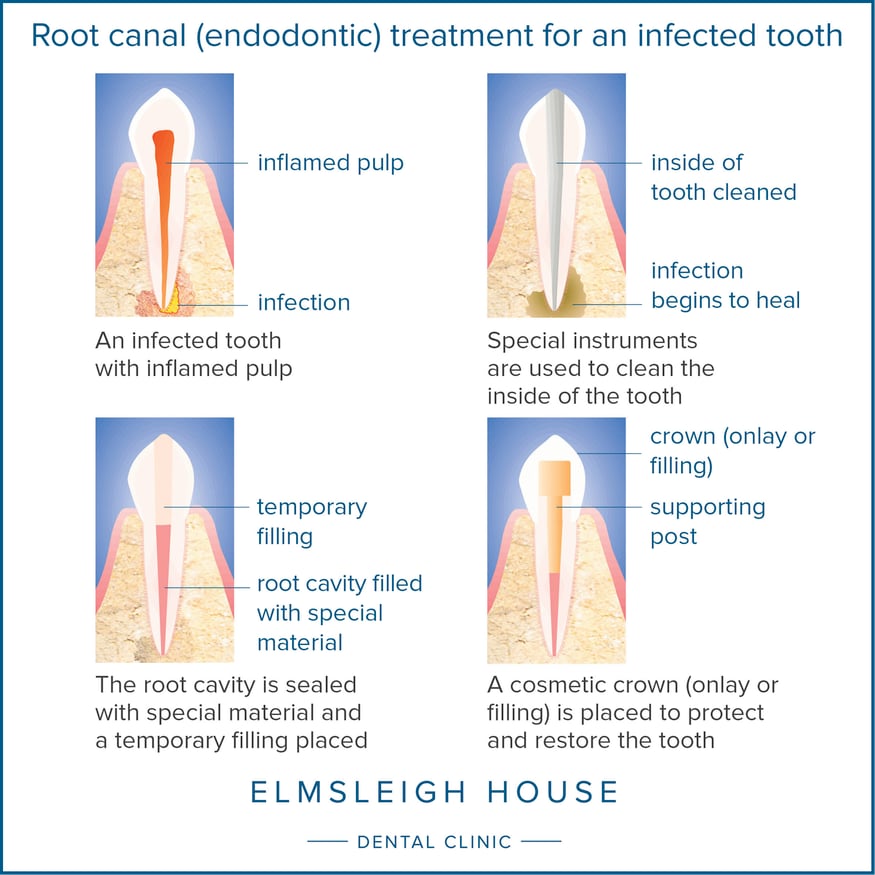 Root Canal Treatment | Elmsleigh House Dental Clinic